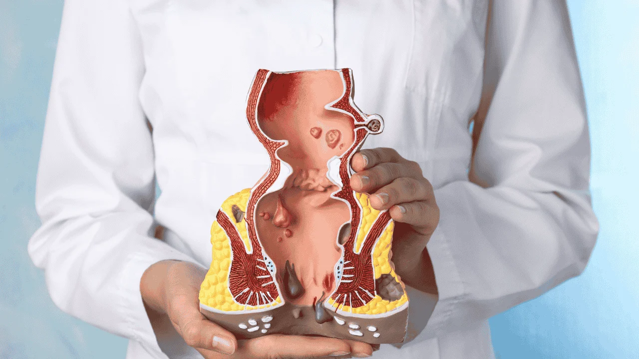Laser Treatment For Anal Fistula Effective Relief